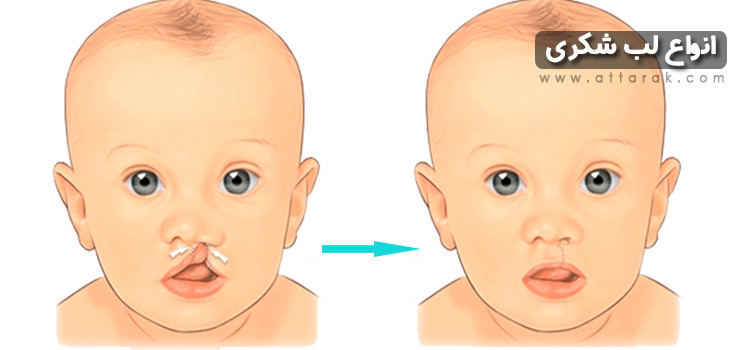 علت ایجاد اختلال لب شکری و شکاف کام چیست |‌ عطارک